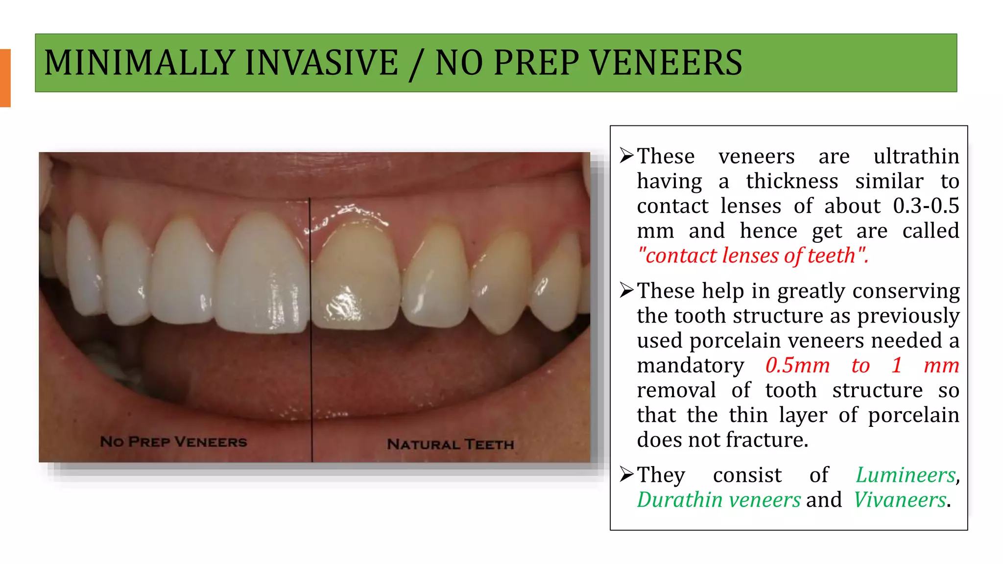 Laminates Veneers in Dentistry | PPTX