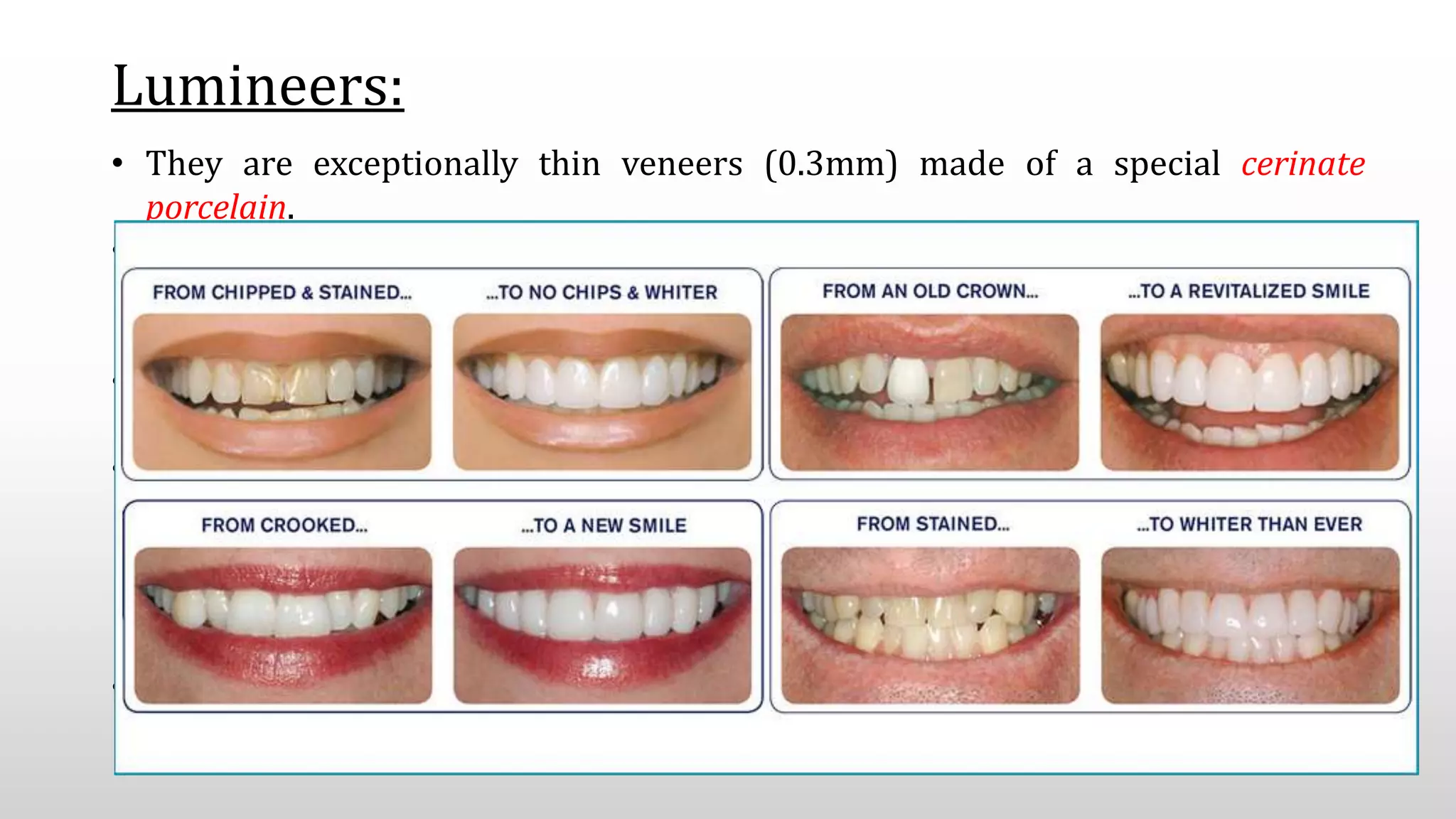 Laminates Veneers in Dentistry | PPTX