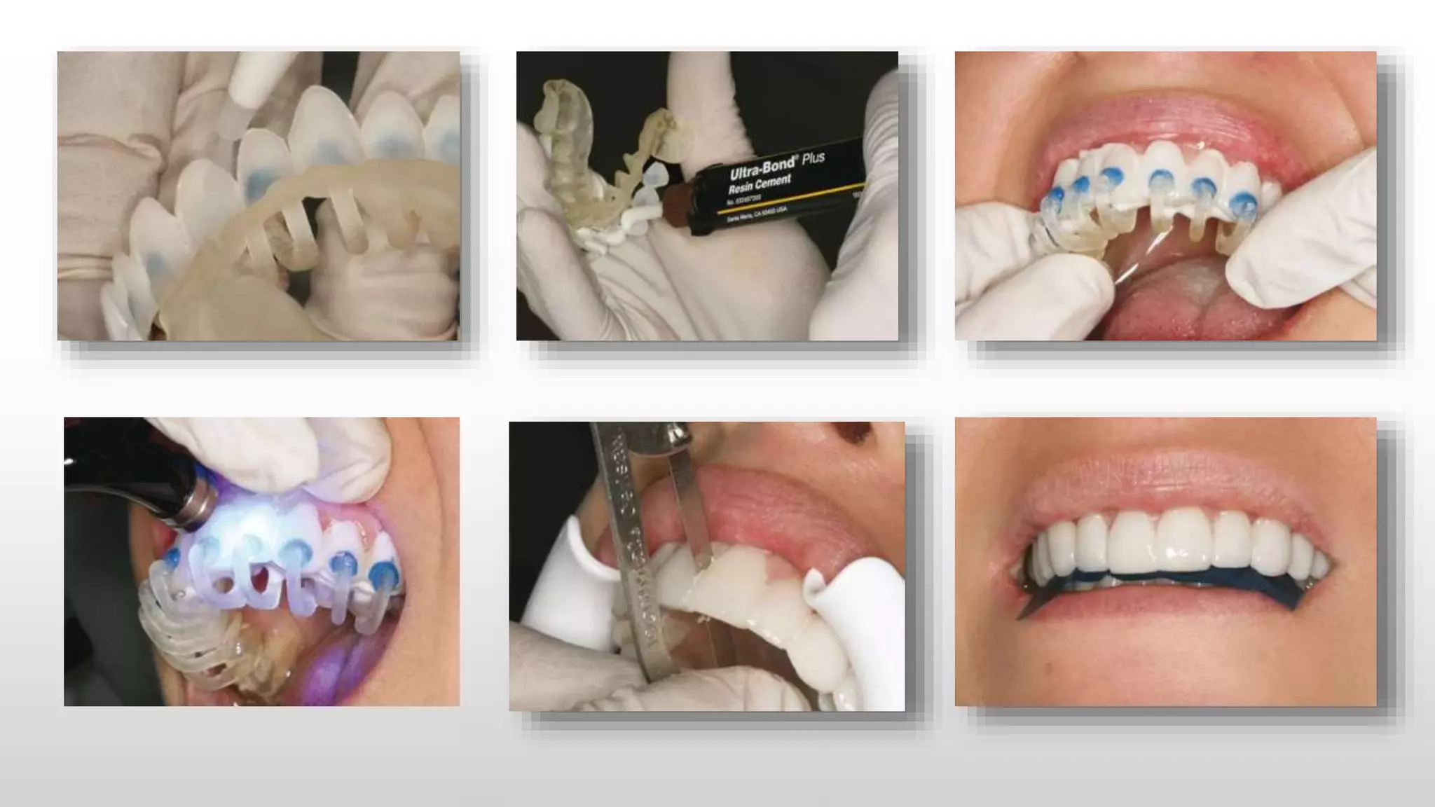 Laminates Veneers in Dentistry | PPTX