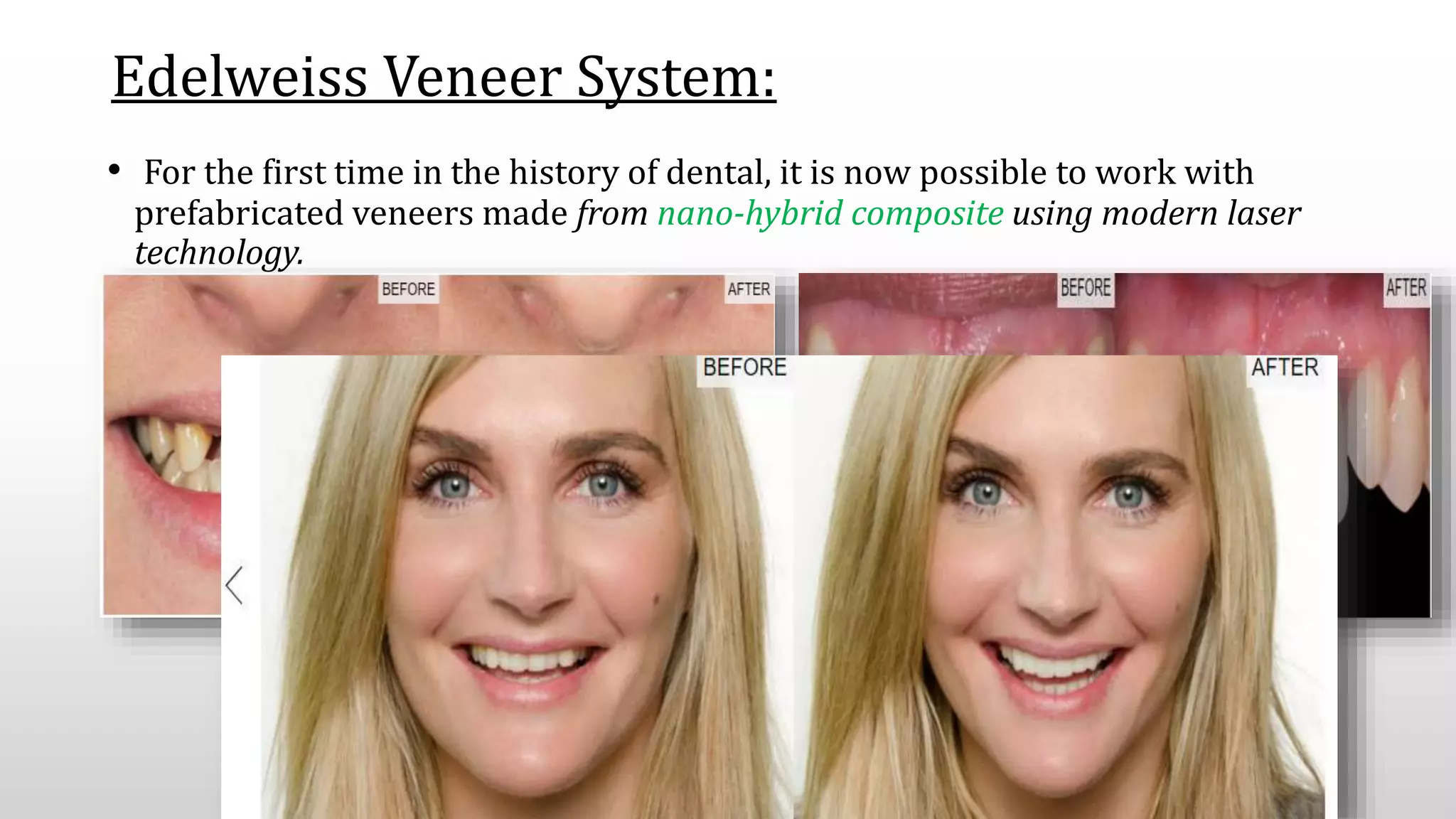 Laminates Veneers in Dentistry | PPTX