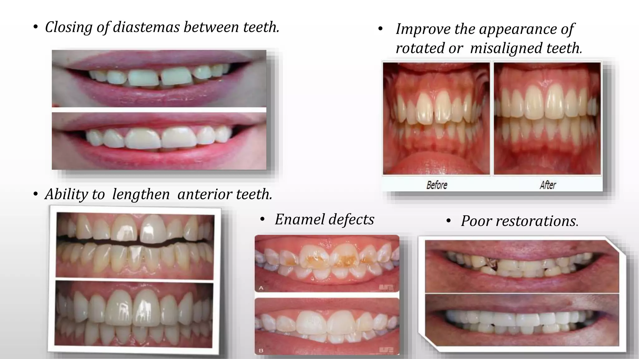 Laminates Veneers in Dentistry | PPTX