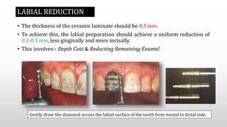 Laminates Veneers in Dentistry | PPTX
