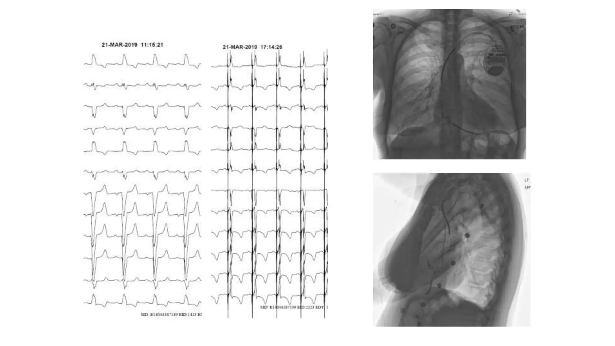 Estimulacion del his como resincronizacion | PPTX