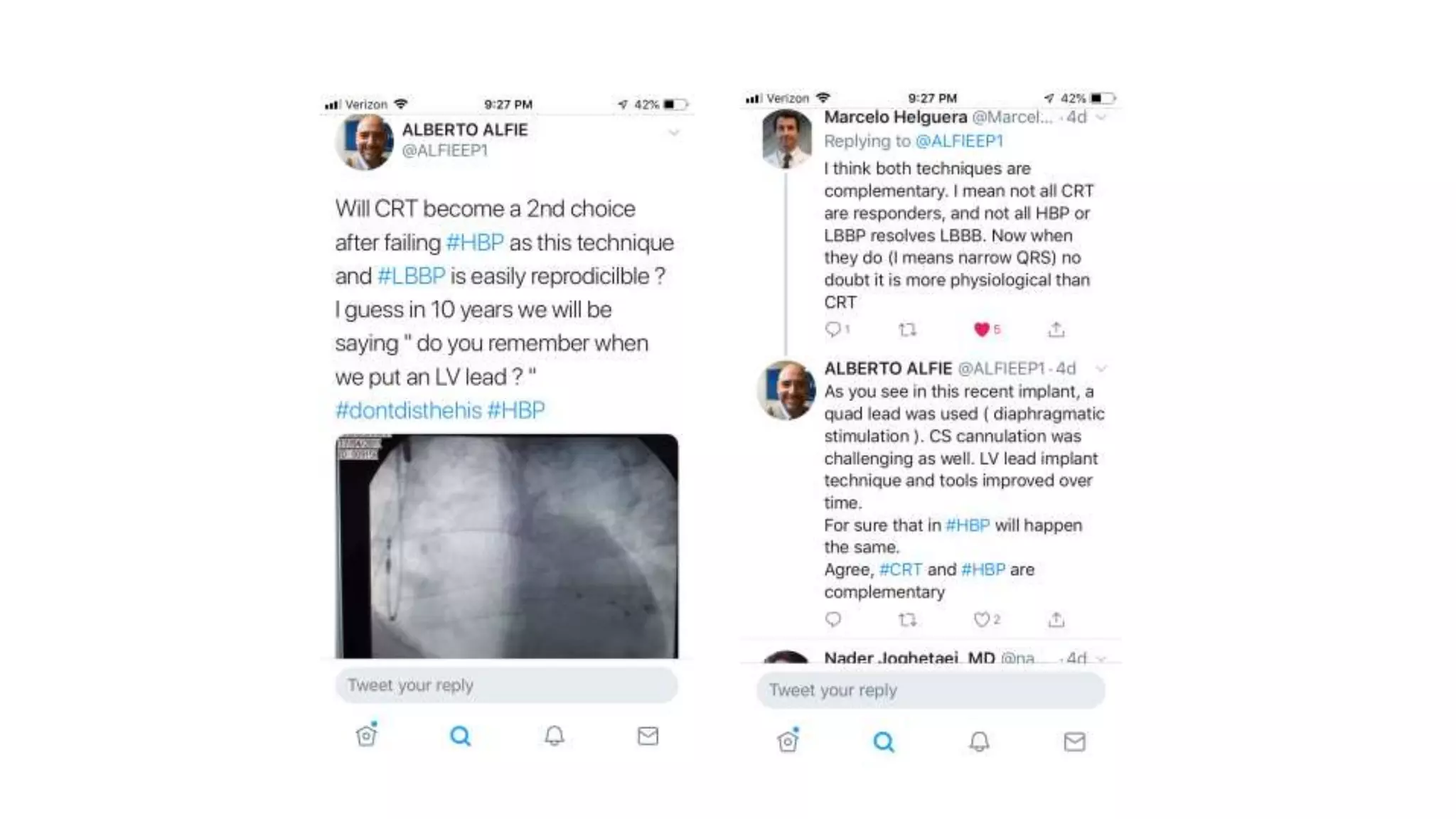 Estimulacion del his como resincronizacion | PPTX