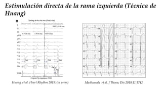 Estimulacion del his como resincronizacion | PPTX