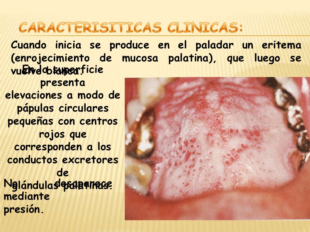Estomatitis nicotinica