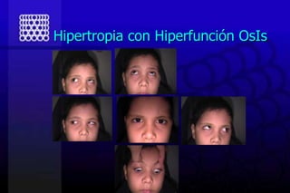 Estrabismo-verticales.ppt