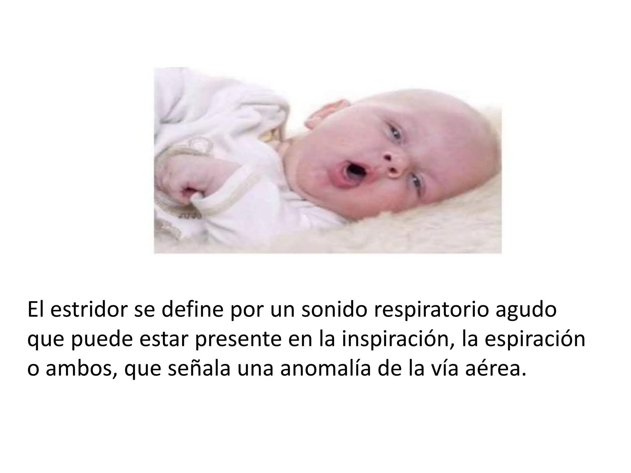 Estridor.pptx.Neonatal laríngeo en pediatría | PPT