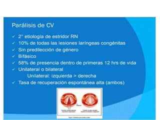 Estridor.pptx.Neonatal laríngeo en pediatría | PPTX