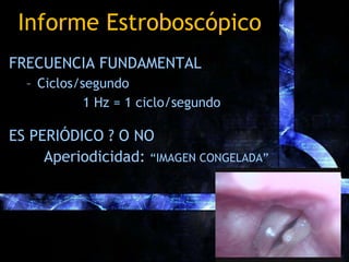 Estroboscopia Laringea