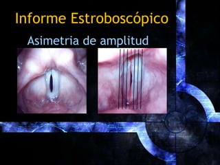 Estroboscopia Laringea