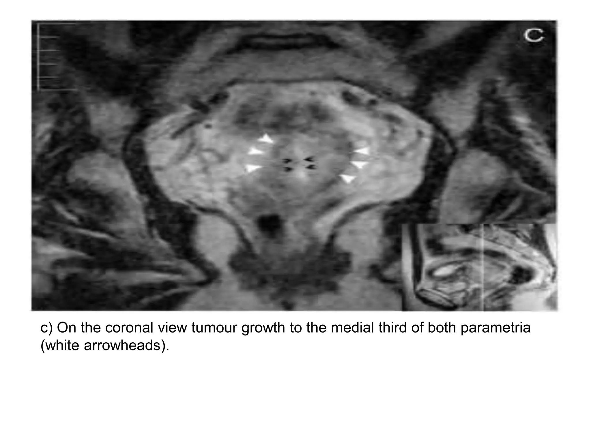 Estro_revised brachy therapy cervical .ppt