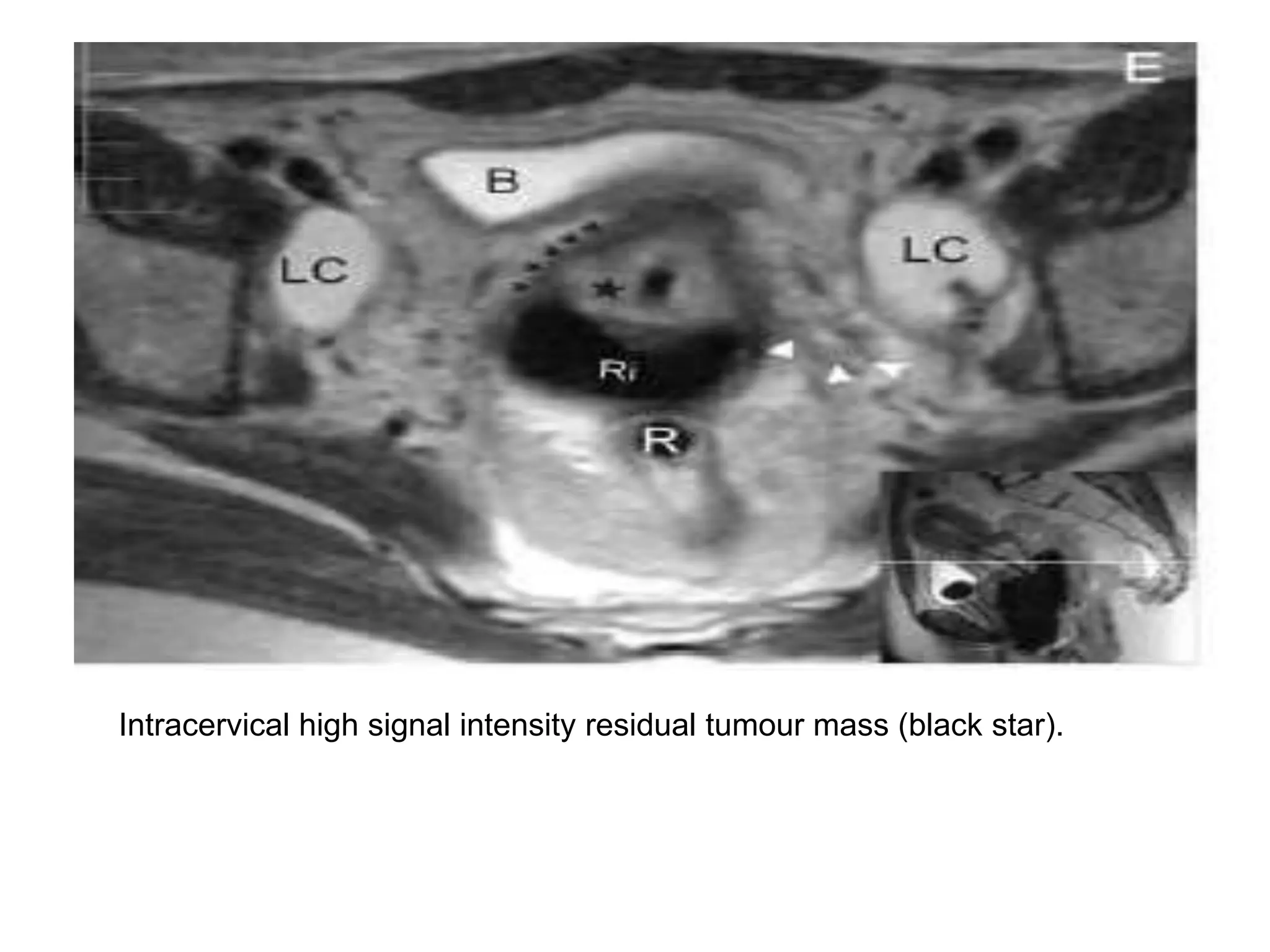 Estro_revised brachy therapy cervical .ppt