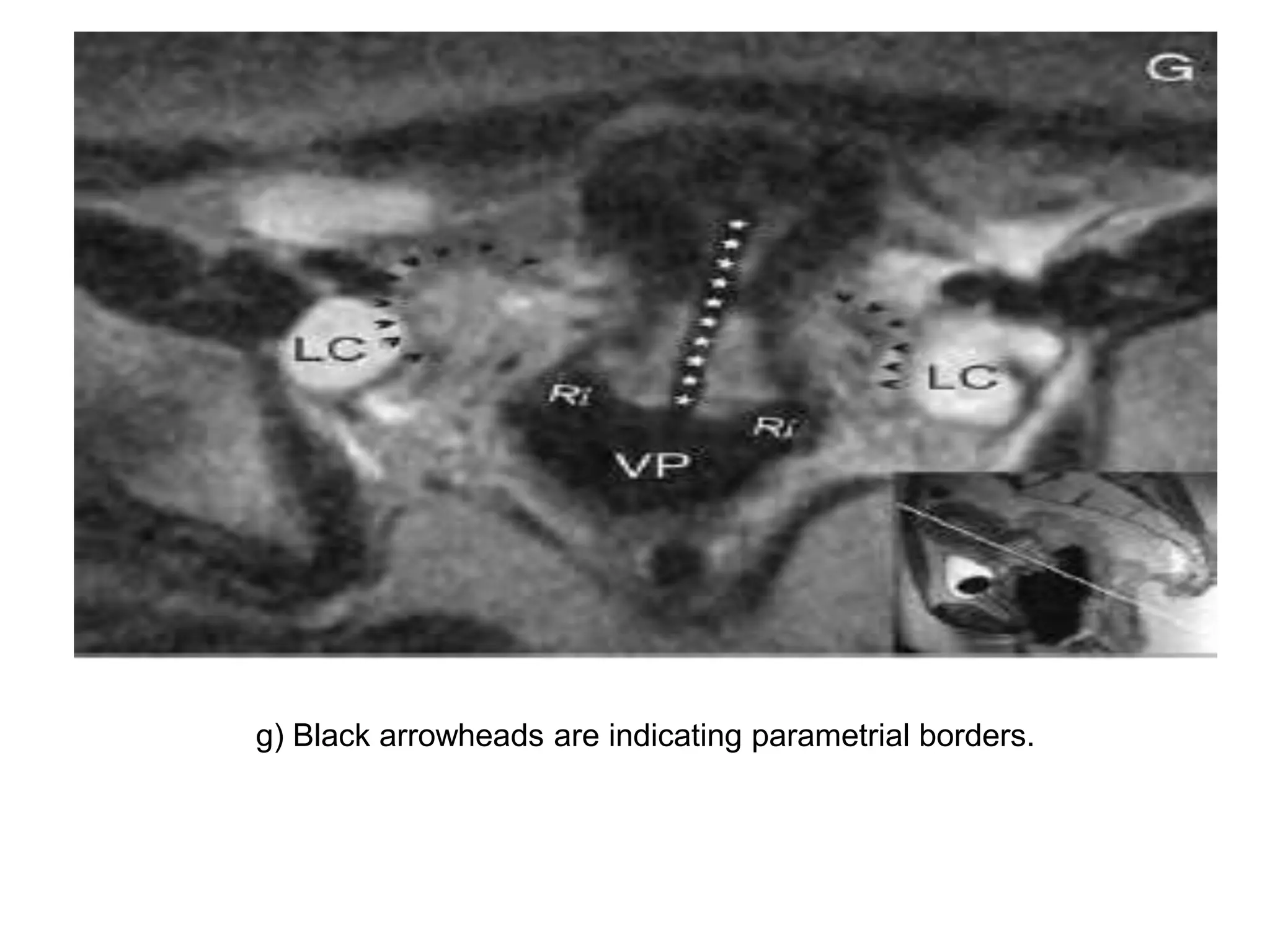 Estro_revised brachy therapy cervical .ppt