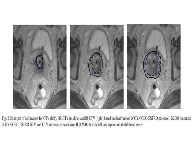 Estro_revised brachy therapy cervical .ppt