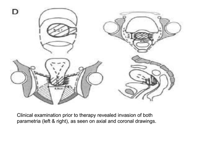 Estro_revised brachy therapy cervical .ppt