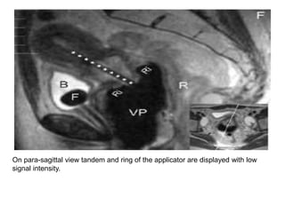 Estro_revised brachy therapy cervical .ppt
