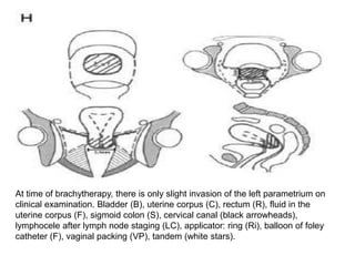 Estro_revised brachy therapy cervical .ppt