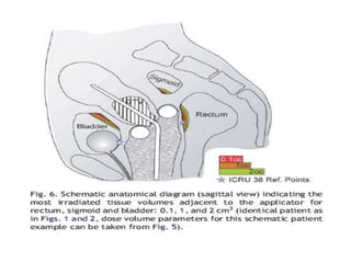 Estro_revised brachy therapy cervical .ppt
