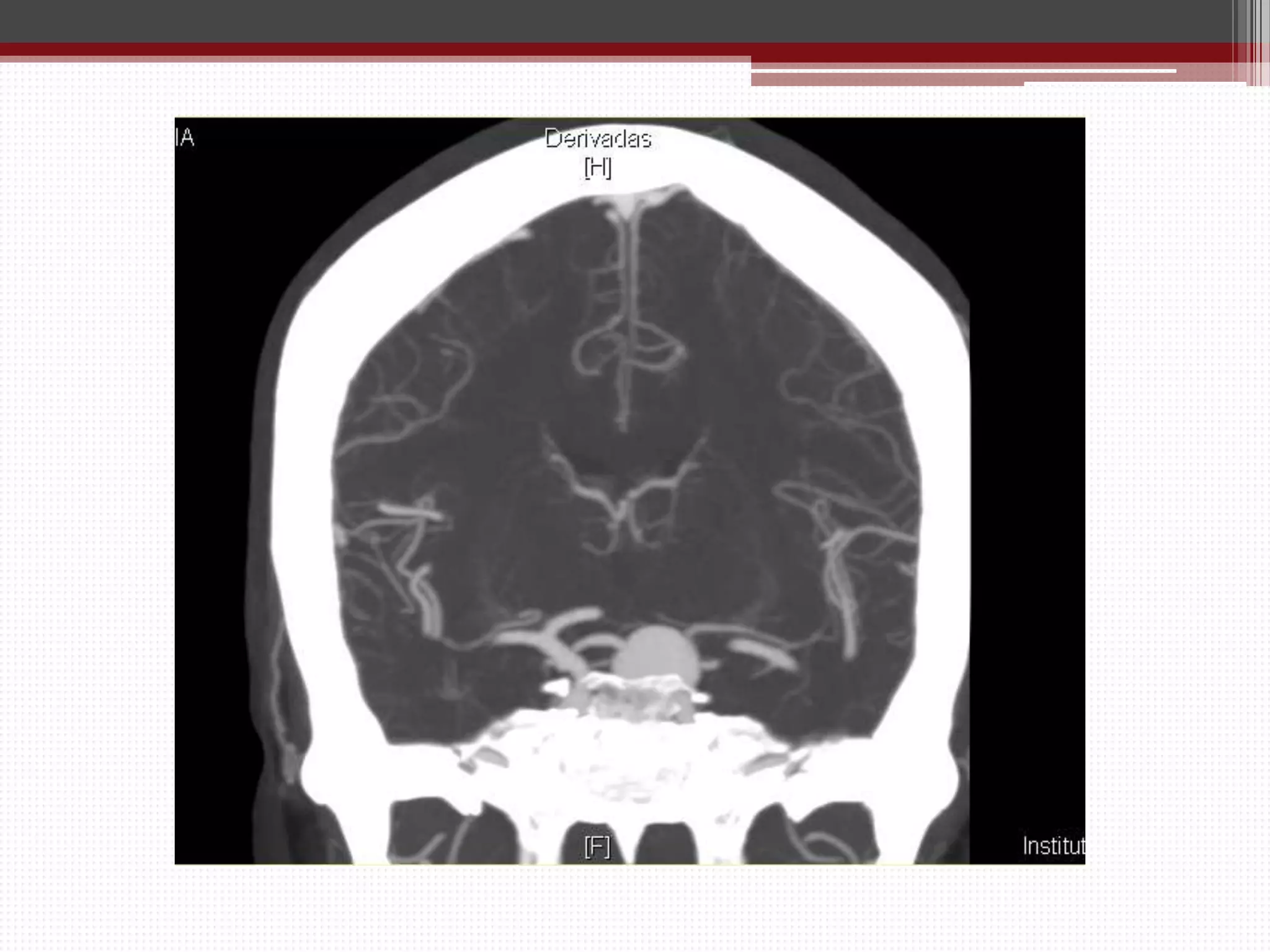 Estudio de aneurisma cerebral mediante angio tc | PPTX