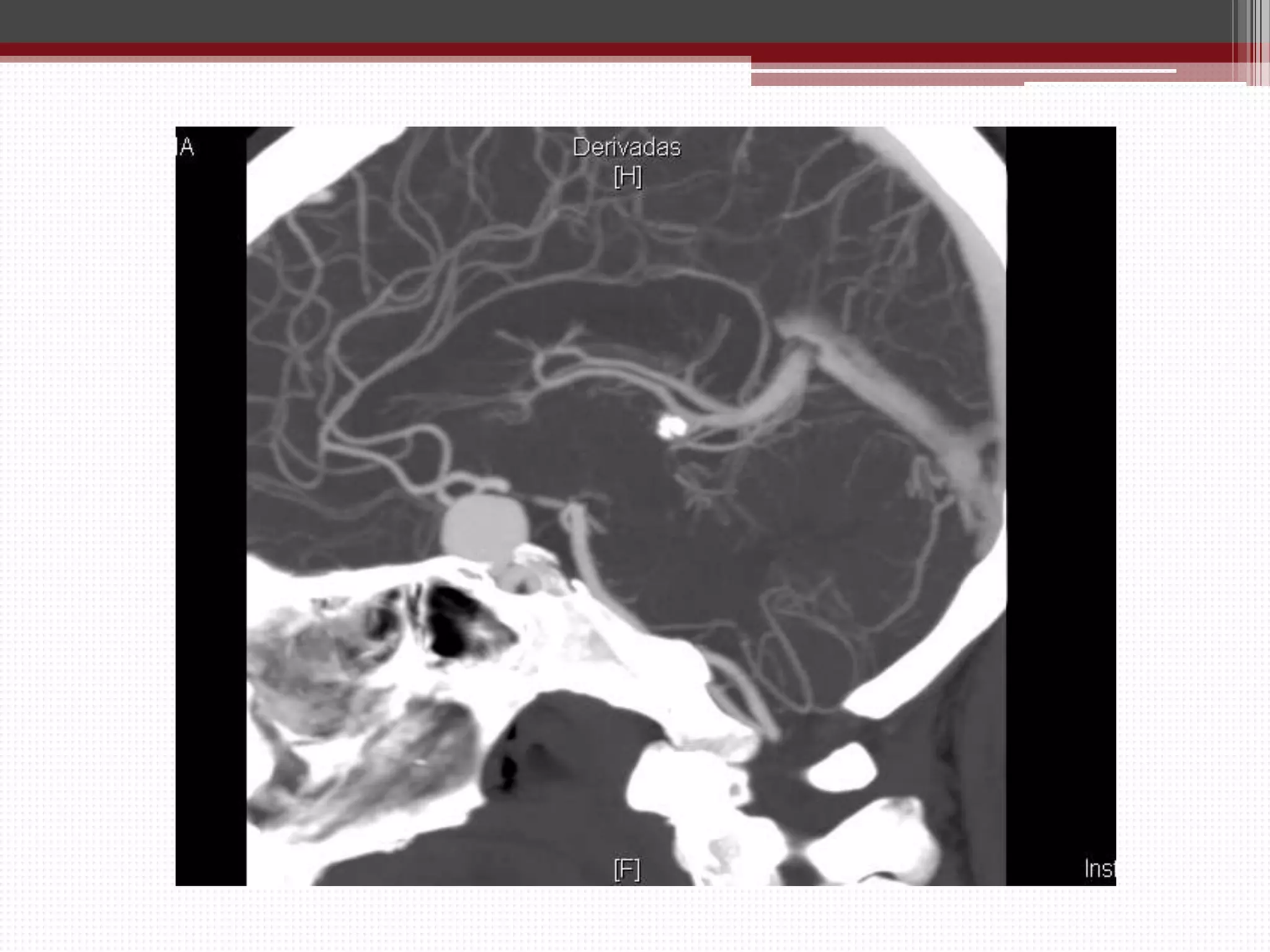 Estudio de aneurisma cerebral mediante angio tc | PPTX