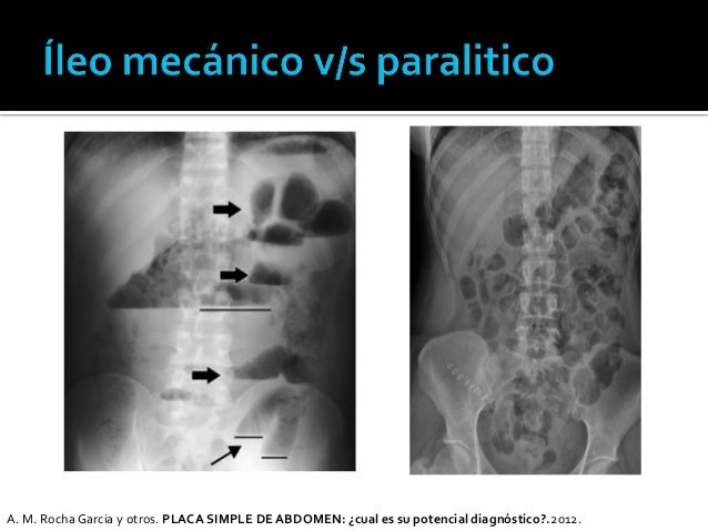 Estudio imagenológico de obstrucción intestinal