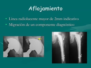 Estudio radiografico cadera y pelvis.ppt