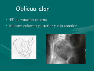 Estudio radiografico cadera y pelvis.ppt
