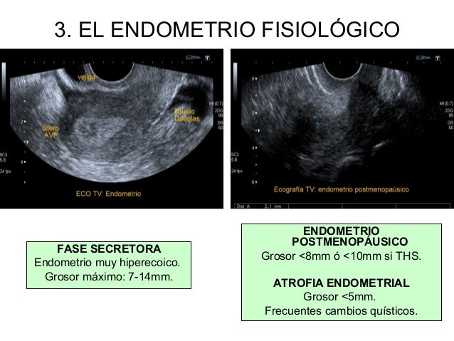 Estudio radiológico del endometrio. Lola Fernández de la Fuente Bursón