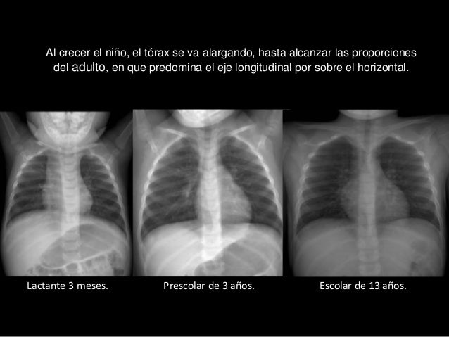 Estudio radiologico del torax en pediatria septiembre 2015 ag 2016 hg…