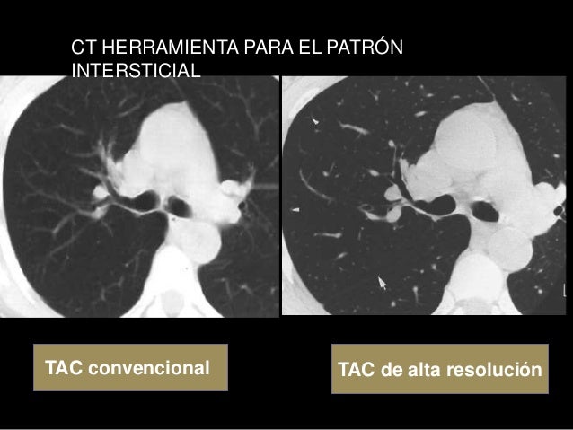 Tac Torax Patron Nodular