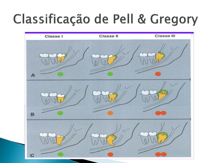 Estudo dos dentes inclusos