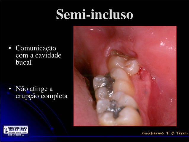 Estudo dos dentes inclusos 2013