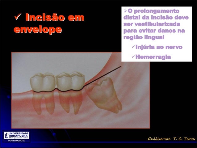Estudo dos dentes inclusos 2013