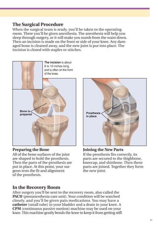 E Sur - Total Knee Replacement.pdf
