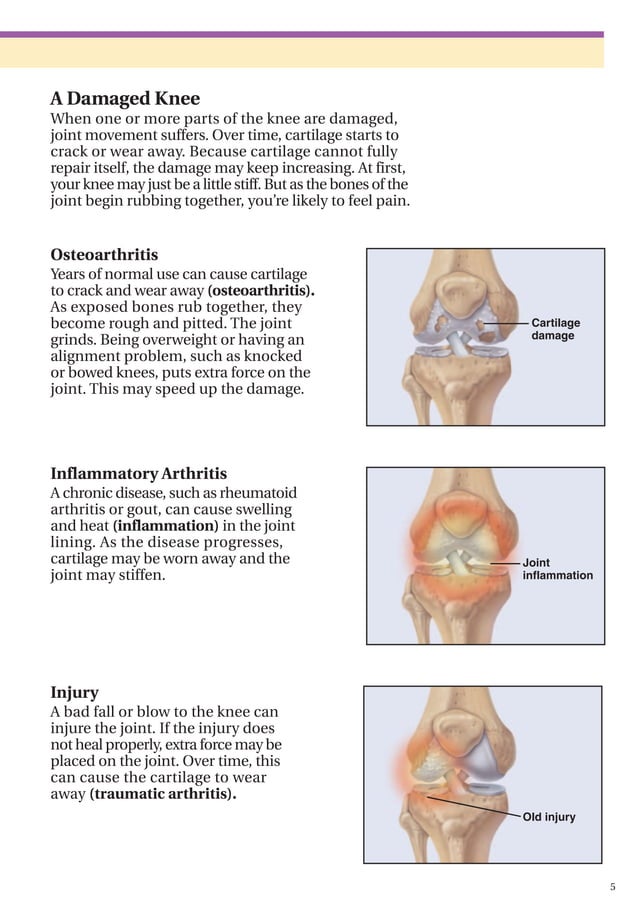 E Sur - Total Knee Replacement.pdf | Bone and Joint Conditions ...