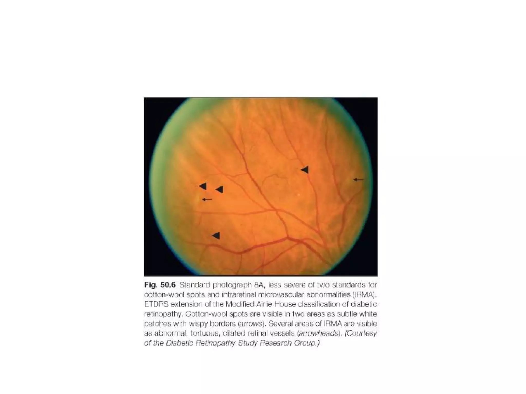 Diabetic retinopathy -Etdrs | PPTX