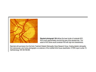 Diabetic retinopathy -Etdrs | PPTX