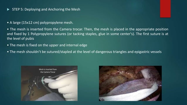 EXTENDED TOTALLY EXTRA-PERITONEAL REPAIR {eTEP} | PPTX
