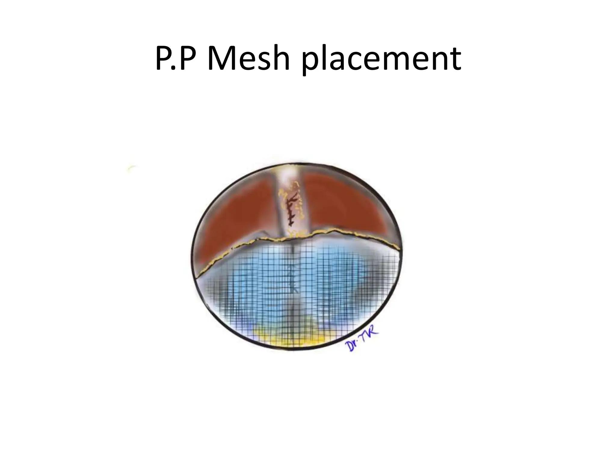 eTEP -RS Dr.TVR.pptx