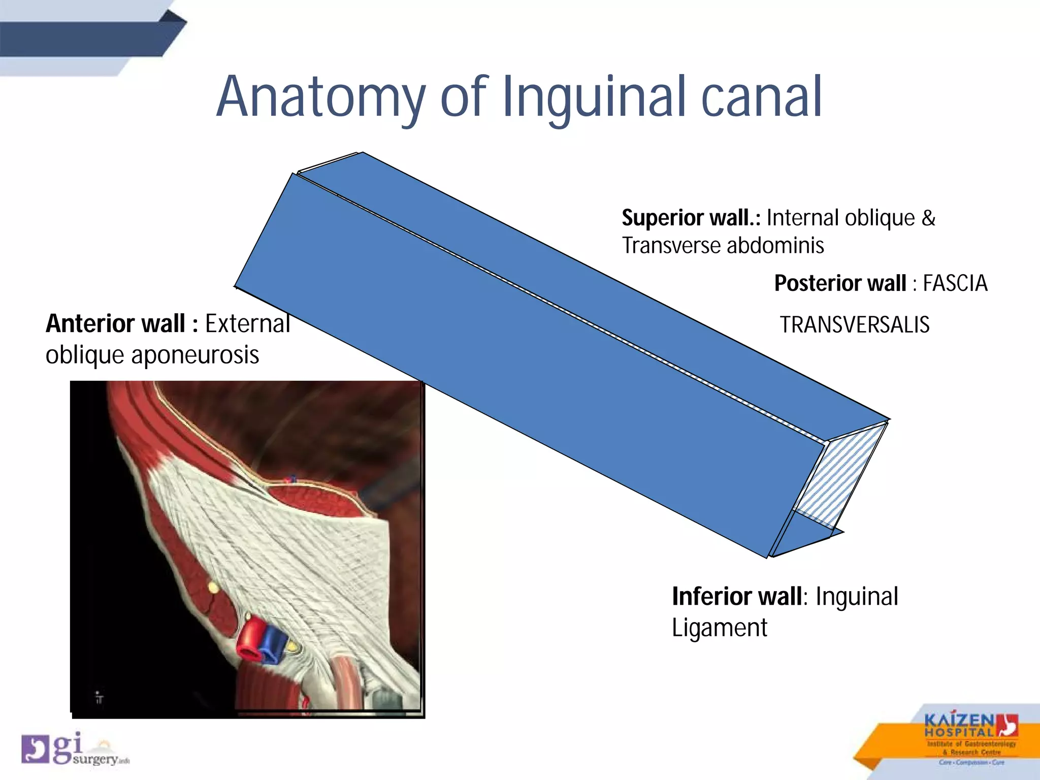 eTEP_for_Inguinal Hernias_Dr_Sanjiv_Haribhakti_www.gisurgery.info (1).pdf