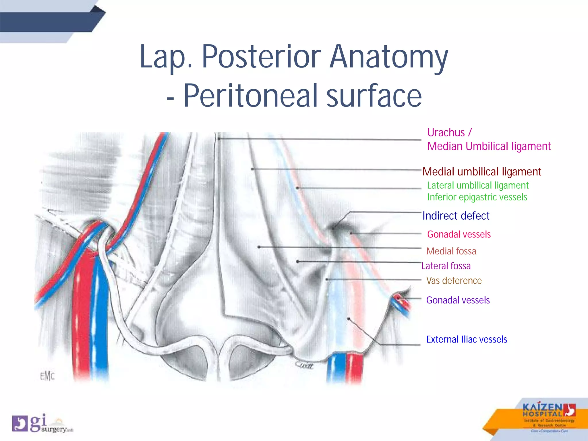 eTEP_for_Inguinal Hernias_Dr_Sanjiv_Haribhakti_www.gisurgery.info (1).pdf