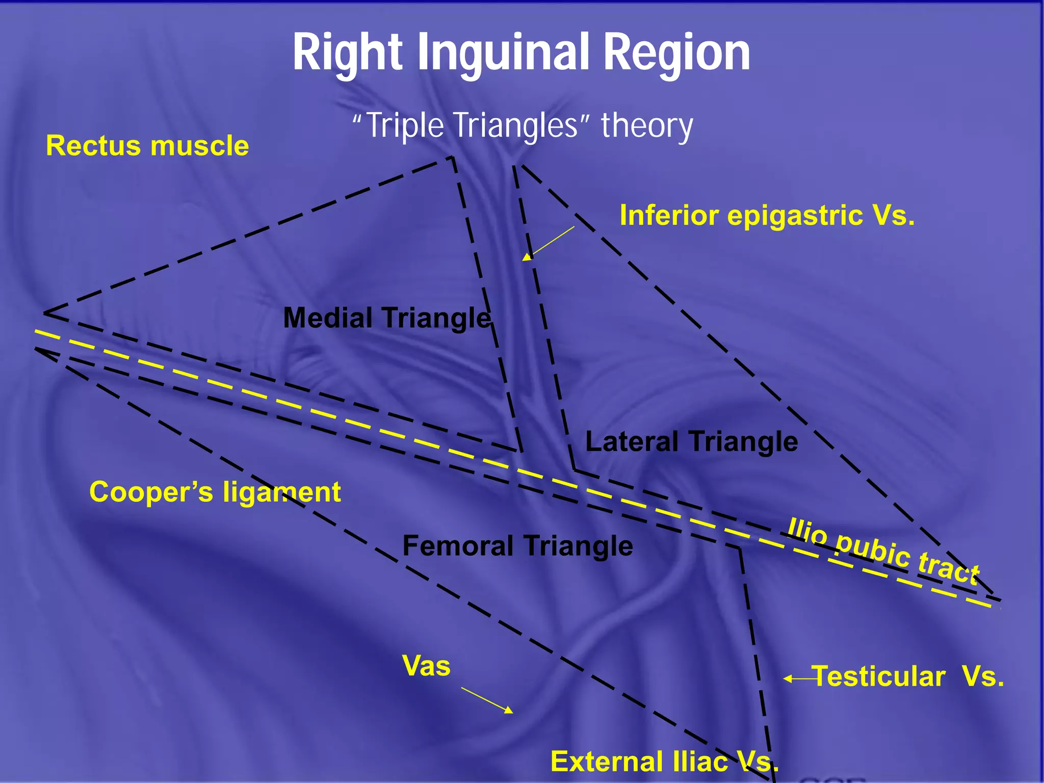 eTEP_for_Inguinal Hernias_Dr_Sanjiv_Haribhakti_www.gisurgery.info (1).pdf