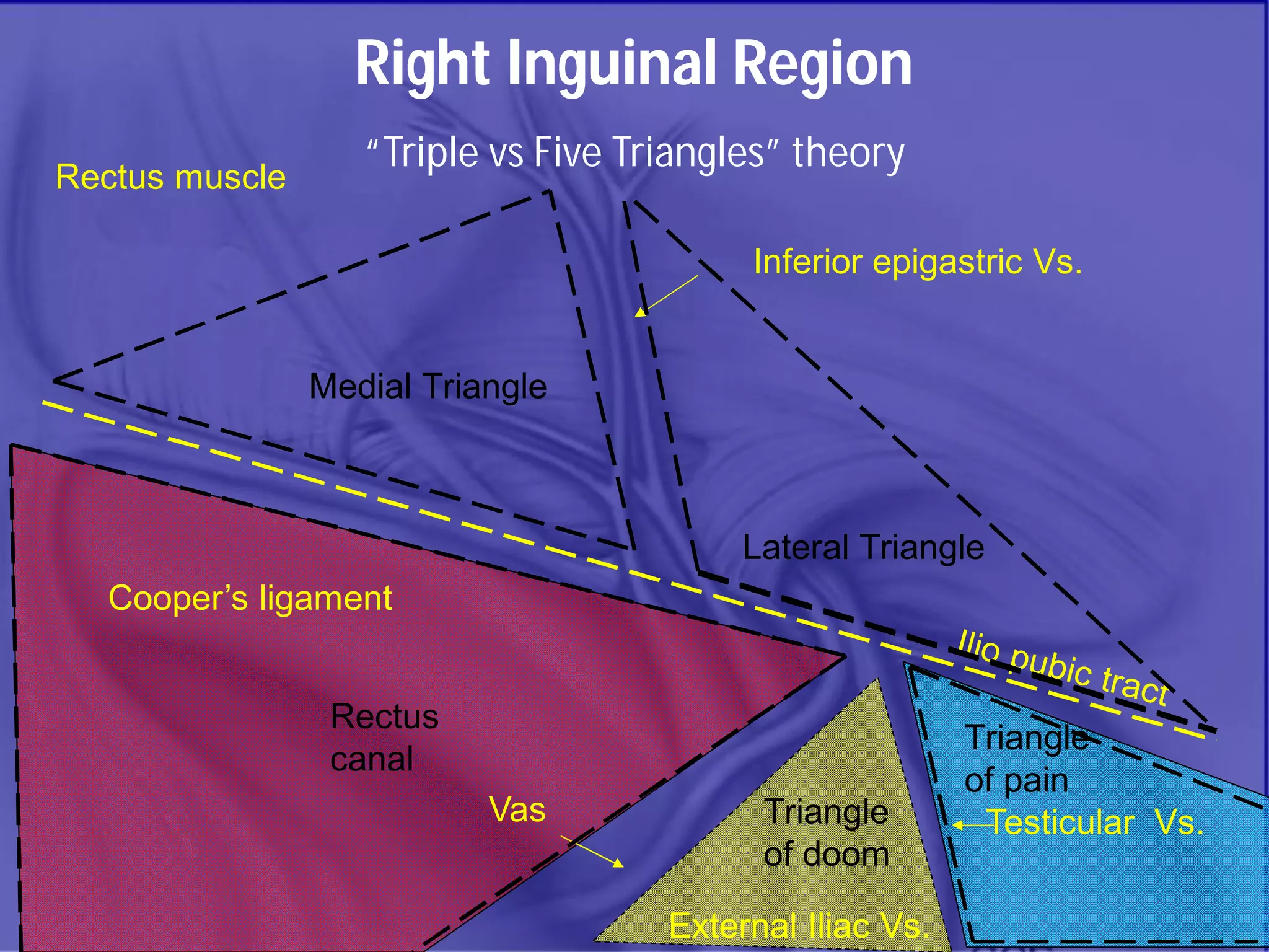 eTEP_for_Inguinal Hernias_Dr_Sanjiv_Haribhakti_www.gisurgery.info (1).pdf