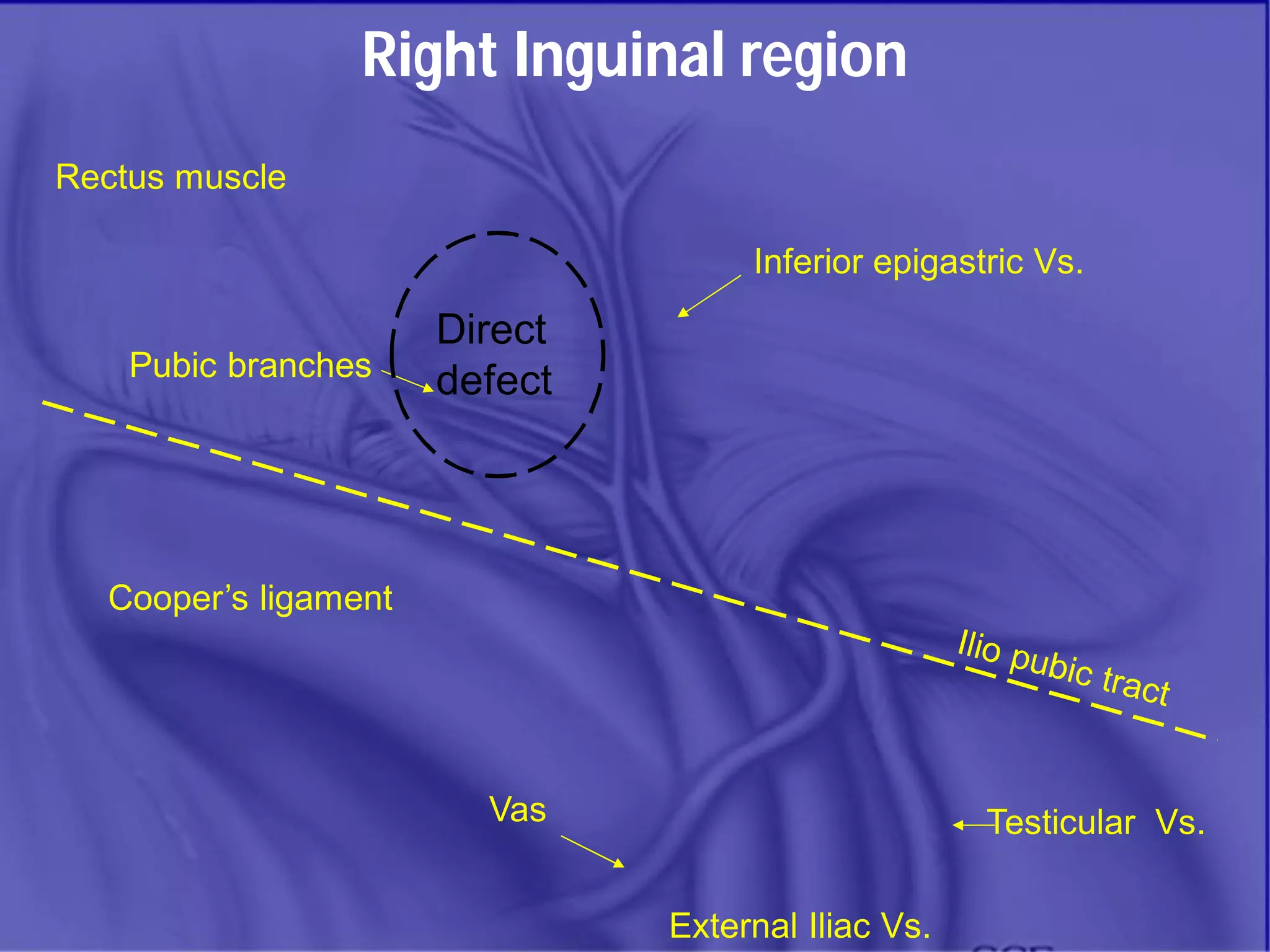 eTEP_for_Inguinal Hernias_Dr_Sanjiv_Haribhakti_www.gisurgery.info (1).pdf