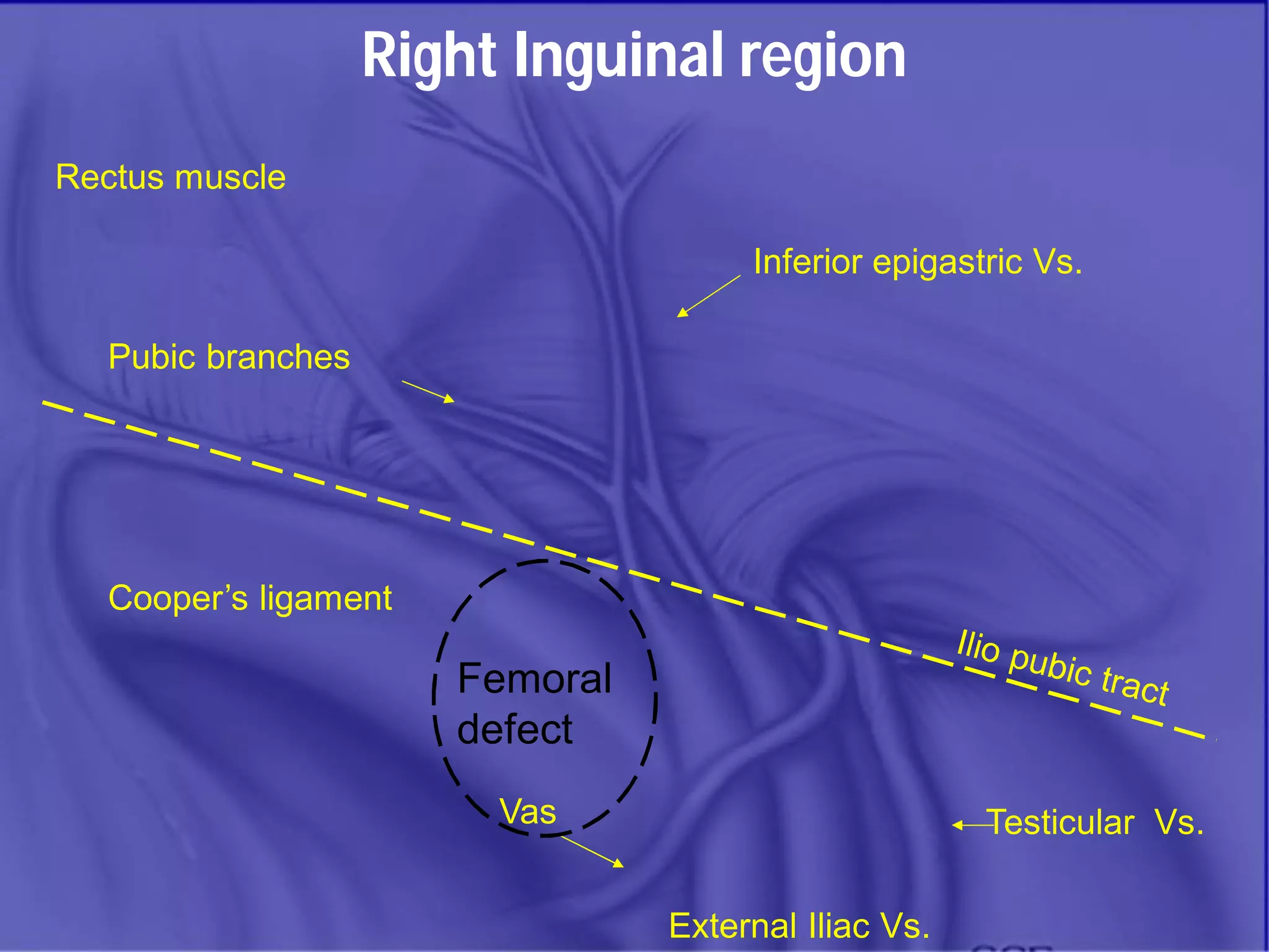eTEP_for_Inguinal Hernias_Dr_Sanjiv_Haribhakti_www.gisurgery.info (1).pdf