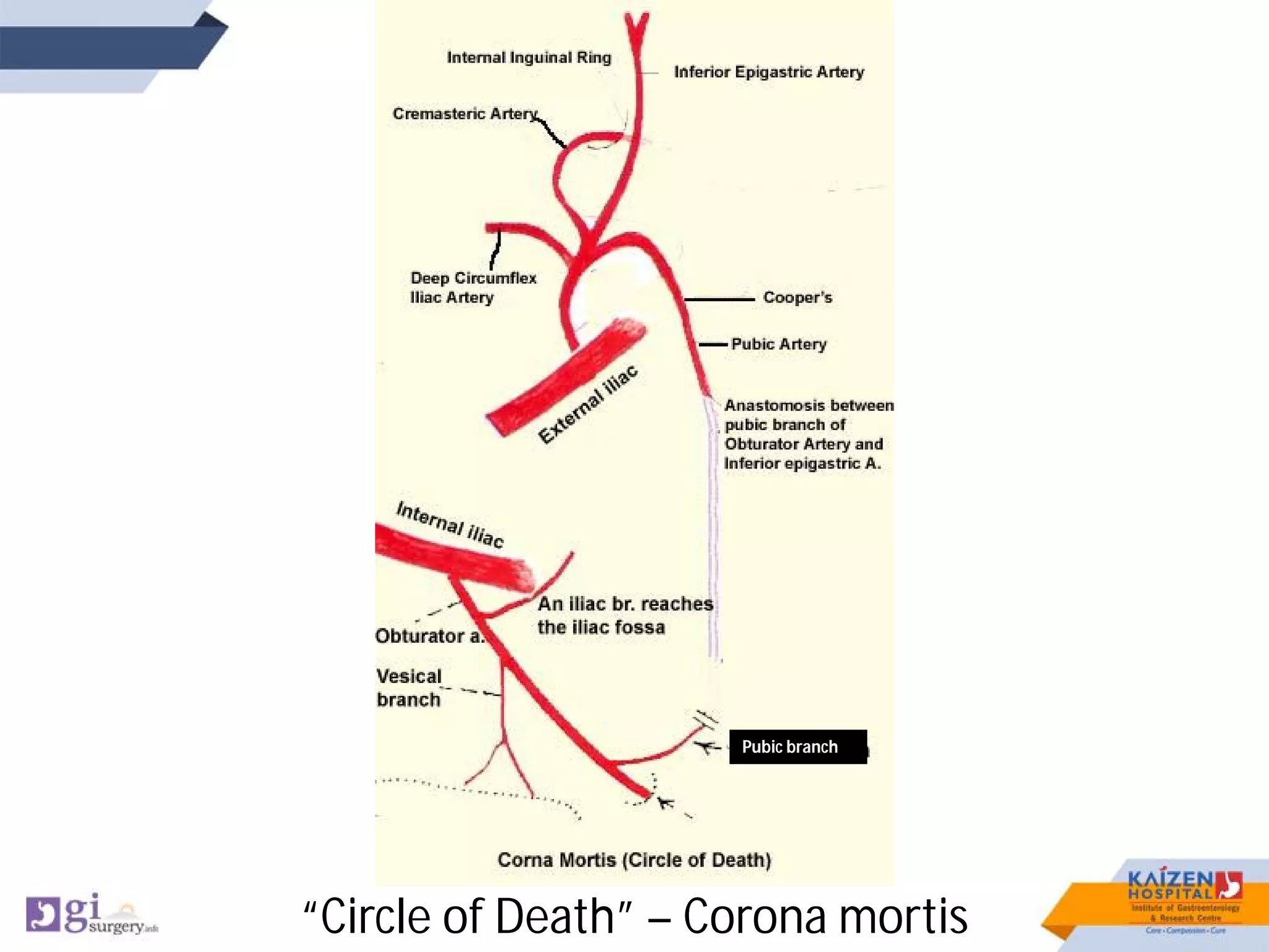 eTEP_for_Inguinal Hernias_Dr_Sanjiv_Haribhakti_www.gisurgery.info (1).pdf