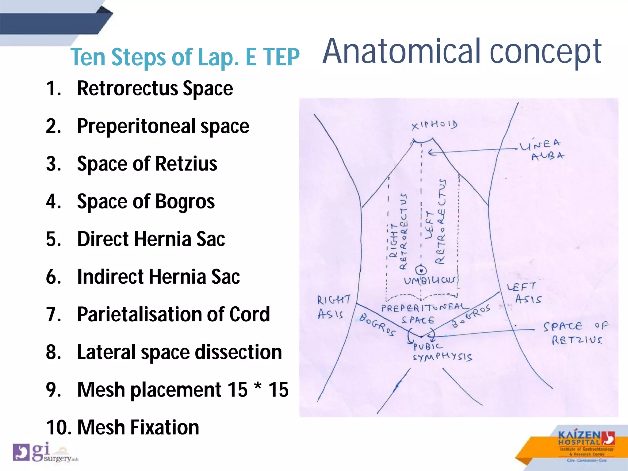 eTEP_for_Inguinal Hernias_Dr_Sanjiv_Haribhakti_www.gisurgery.info (1).pdf
