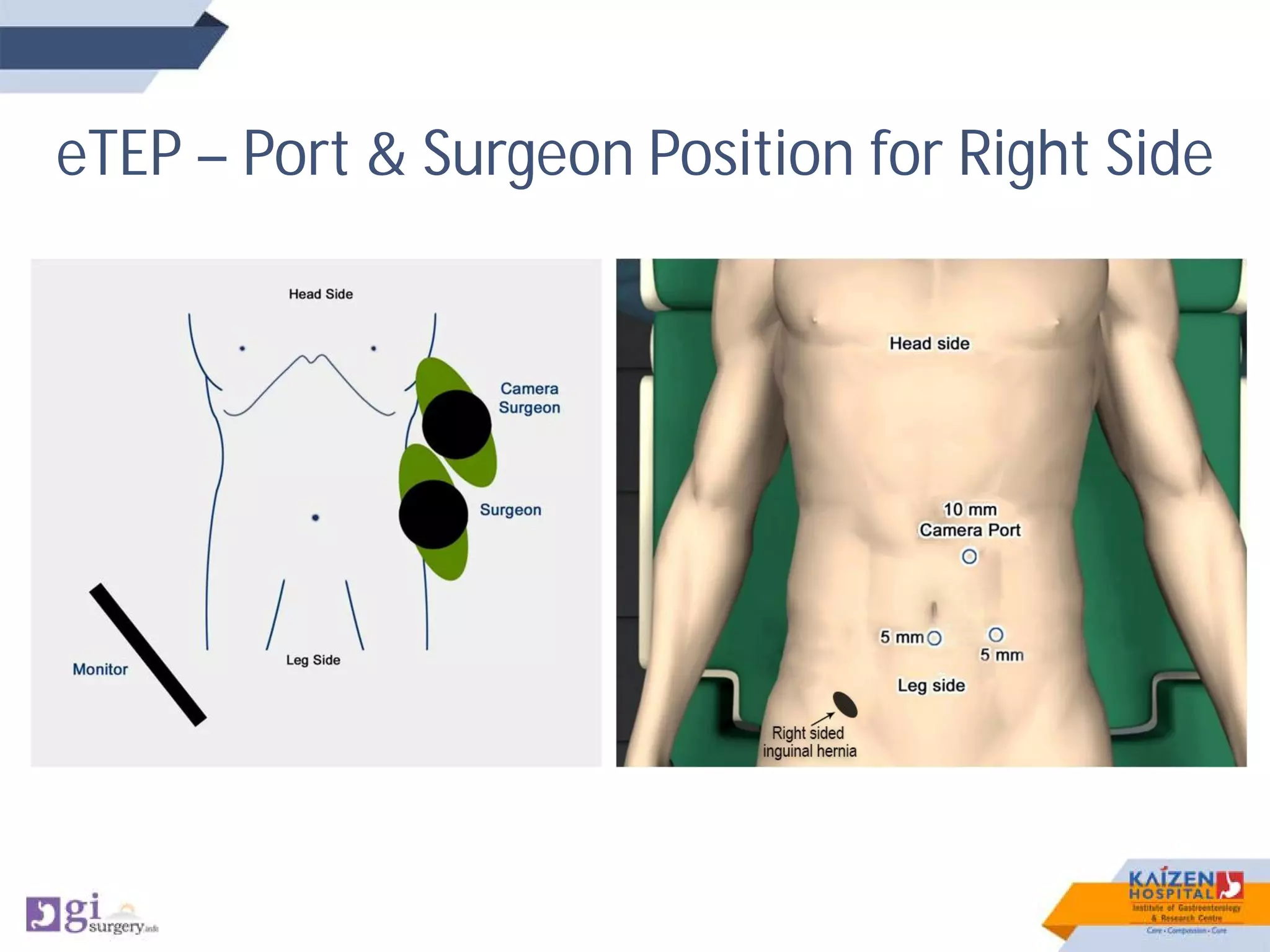 Etep For Inguinal Hernias Dr Sanjiv Haribhakti 1 Pdf
