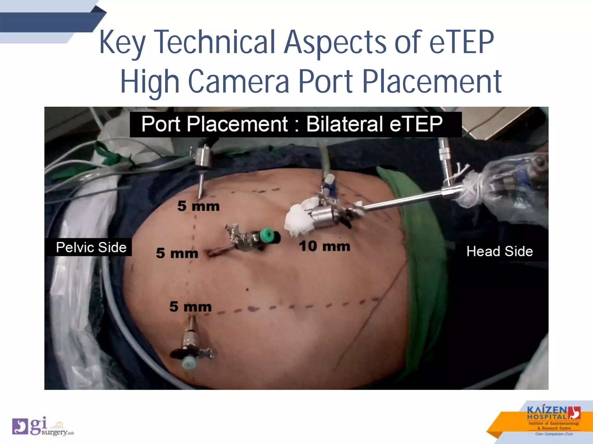 eTEP_for_Inguinal Hernias_Dr_Sanjiv_Haribhakti_www.gisurgery.info (1).pdf